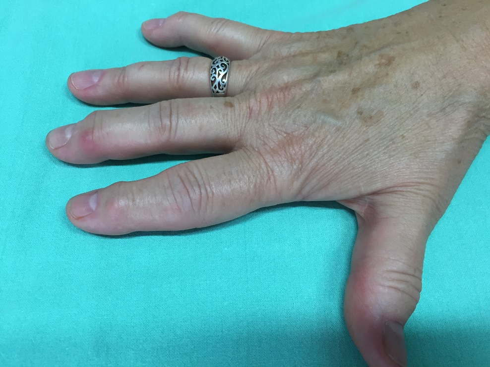 Osteoartrosi della mano | ior